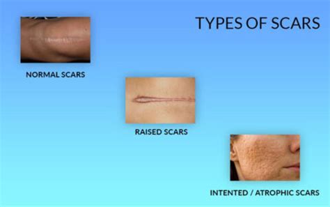 Types Of Scars Dr Venus