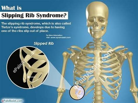 Slipping Rib Syndrome Artofit
