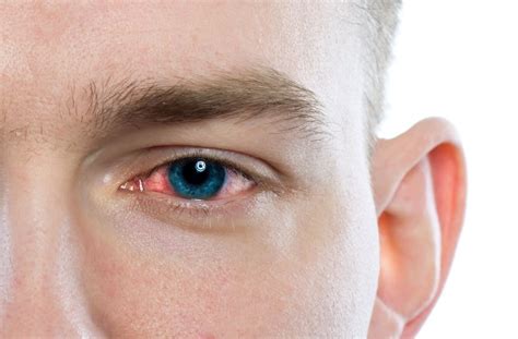 Conjunctivitis Pink Eye Articles On Causes Symptoms And More
