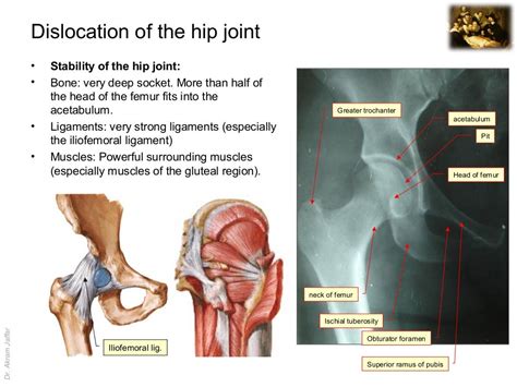 Imaging Anatomy Dislocation Of The Hip Joint