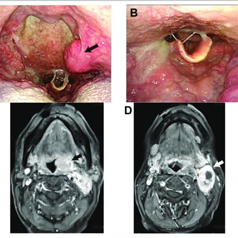 Tonsil Cancer Findings With Transoral Endoscopy And Contrast Enhanced