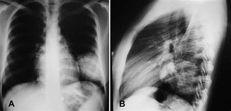 Chest X Ray Showing A Homogeneous Wide Pleural Base Opacity In The