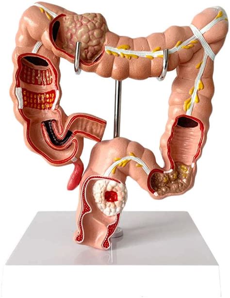 Hscylwj Body Model Human Large Intestine Anatomical Model Colon Pathology Desertcart Gb