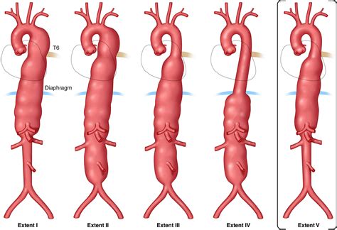 2022 Accaha Guideline For The Diagnosis And Management Of Aortic