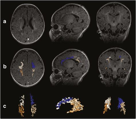 Three Dimensional Segmentation A The T1 Weighted Image Prior To