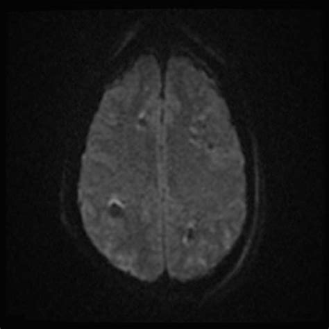 Diffuse Axonal Injury Wikidoc