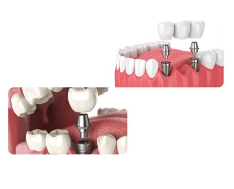 Dental Implant Treatment Devgedent