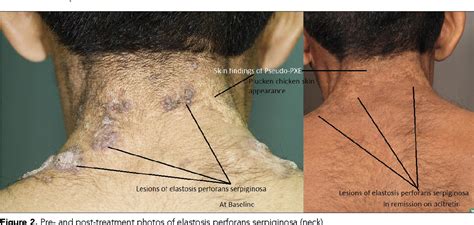 Figure 2 From D Penicillamine Induced Pseudo Pseudoxanthoma Elasticum And Extensive Elastosis