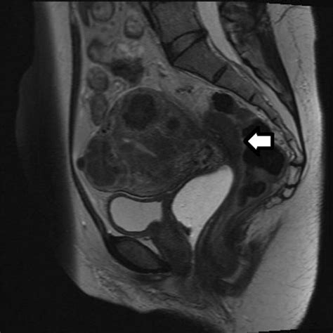 T2 Weighted Sagittal Mr Image In A Patient With Significant Cyclic