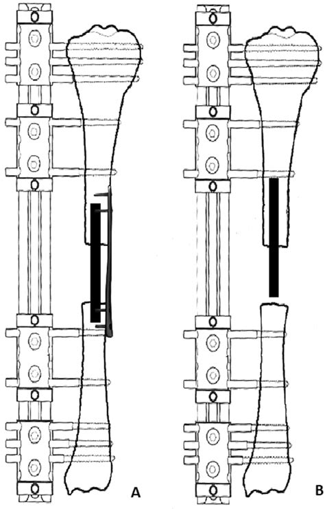 Illustration Of The Operative Technique Of Placement And Removal Of The Download Scientific