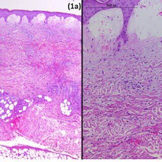 A A Scanning Power View Showing Subepidermal Edema And A Diffuse Download Scientific Diagram