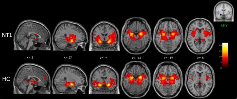 Amygdala Amy Functional Connectivity Networks In Nt1 Patients And