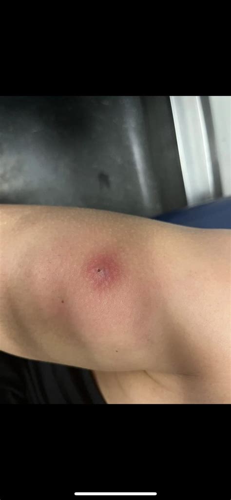 Does This Look Like A Tic Bite R Lymedisease