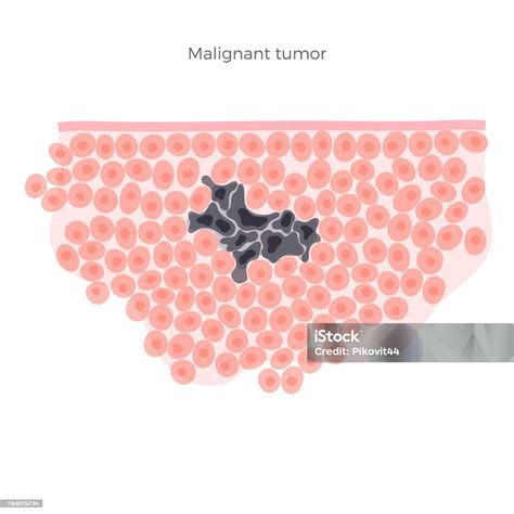Vector Isolated Illustration Of Malignant Tumor Stock Illustration