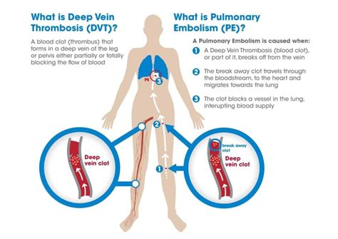 Dvt Specialist Singapore