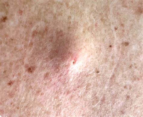 Epidermoid Cyst Symptoms Causes And Treatment