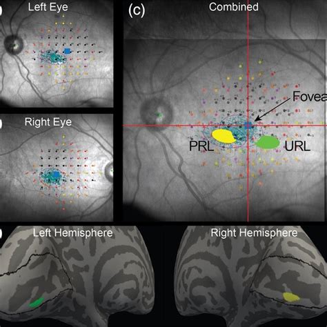 Normalized Thickness Across Eccentricity Regions Of Interest Rois