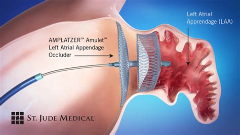 2017 Af Symposium Live Video 2 Procedures Different Laa Occlusion Devicesatrial Fibrillation