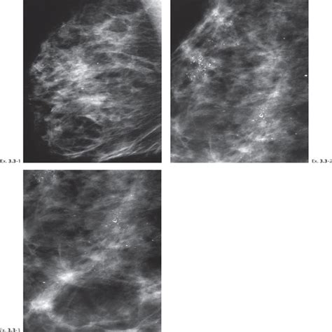 Multiple Clusters Of Crushed Stone Like Calcifications On The Mammogram Produced By Malignant