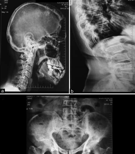 A Lateral Skull View Showing Increased Width Of Diploic Spaces Download Scientific Diagram
