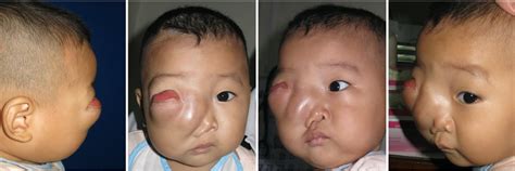 Large Isolated Nasoorbital Type Of Frontoethmoidal Encephalo