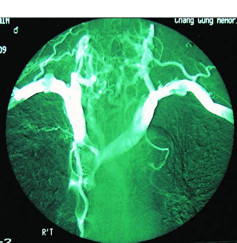 Venography Showed Total Occlusion Of The Svc At The Confluence Of The Download Scientific