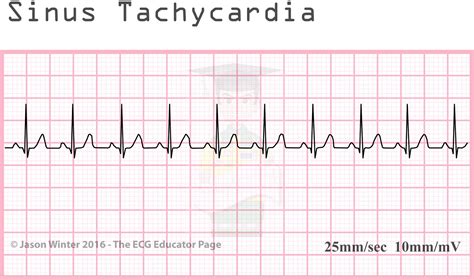 Ecg Educator Blog Sinoatrial Node Rhythms