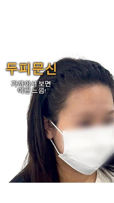 트루닷 성신여대두피문신 성북구두피문신 성북두피문신 얇고 힘없는 모발 머리를 길게 유지했을 때도 잘 보이는 정수리