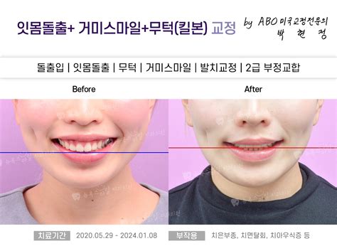 수염은 남성의 패션아이템 수염으로 돌출입을 감추어왔다면 이젠 잇몸돌출교정으로 수염없이 깔끔한 인상 만들어 보세요 어려운 치과교정치료 더 쉽게 이해하실 수 있도록