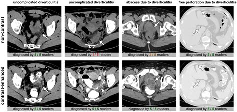 Comparison Of Non Contrast Ct Vs Contrast Enhanced Ct With Both