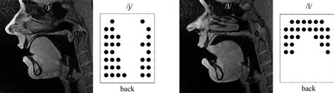 Mr Images And Tongue Palatal Contacts For A Frequent Central And