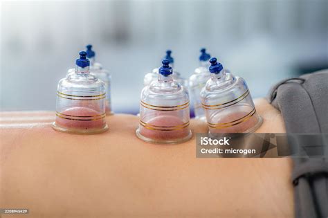 물리 치료 세션 중 등에 부항 치료를 받고 있는 여성 흡입 컵은 근육 긴장을 완화하고 혈액 순환을 개선하며 통증 완화 및 이완을 촉진하는 데 도움이 됩니다 2명에 대한 스톡