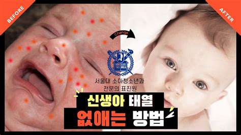 신생아 태열 아토피성 피부염 그냥 방치하지 마세요 신생아 스테로이드 연고 신생아 로션 소아청소년과 의사 표진원의 태열 꿀팁 Youtube