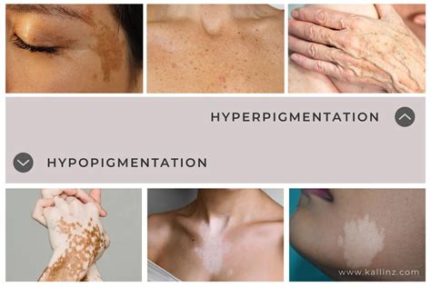 How To Tell If Hyperpigmentation Is Permanent Kallinz