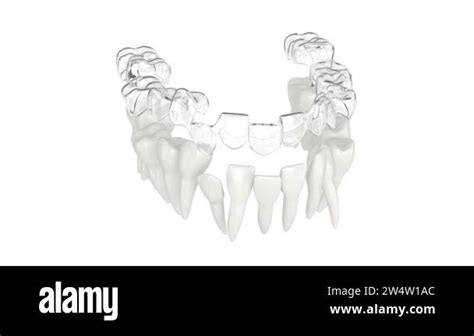 Teeth Splint Stock Videos And Footage Hd And 4k Video Clips Alamy