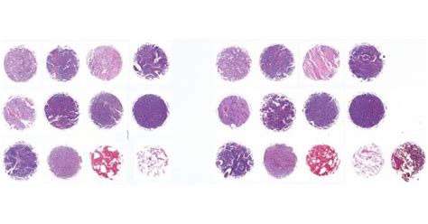 T045g Lung Carcinoma With Normal Lung Tissue Test Tissue Array Including Tnmstage Ajcc 8th