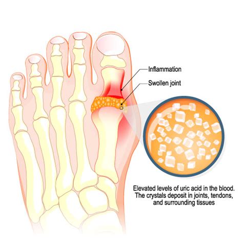 Expert Gout Treatment Brisbane Au