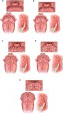 Evaluation Of The Patient With Obstructive Sleep Apnea Friedman Tongue
