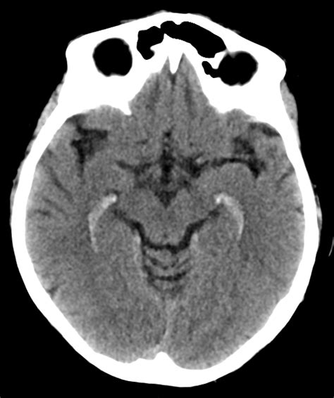 Radiopaedia Case Choroid Plexus Calcification Through The Foramina Of Radiopaedia Case Choroid Plexus Calcification Through The Foramina Of