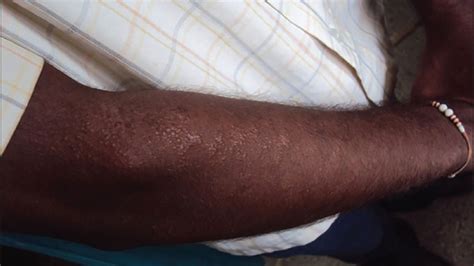 Polymorphic Light Eruption Hands