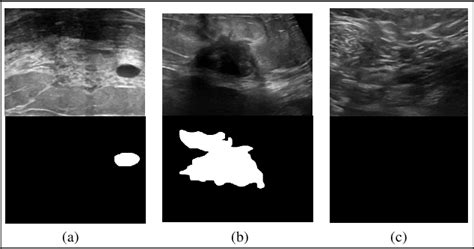 figure 2 from breast cancer segmentation using attention based