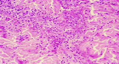 Dermal Vessels Showing Perivascular Infiltration Of Polymorphonuclear Download Scientific