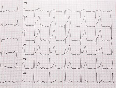 What Is Ventricular Fibrillation YourCareEverywhere