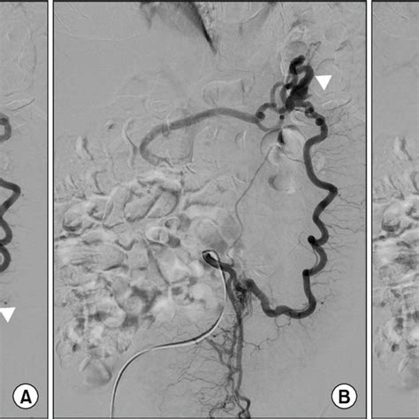Colonoscopy Revealing Ischemic Colitis Edema Minor Ulcerations And