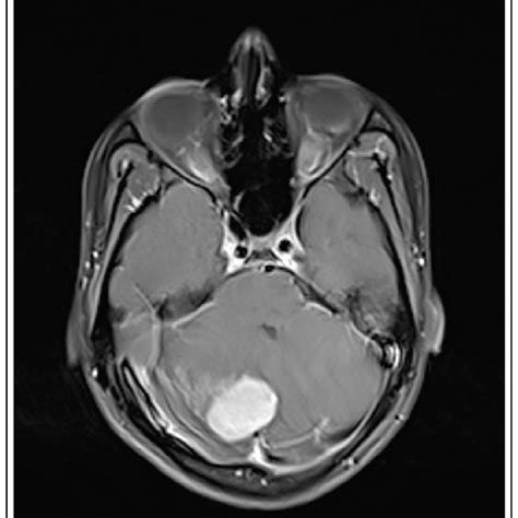 A Ct Brain Plain Axial Image Showing Hyperdense Lesion In The Right Download Scientific