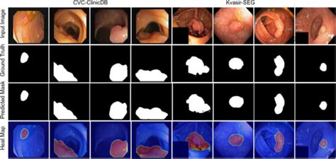 Multi‐scale Nested Unet With Transformer For Colorectal Polyp Segmentation Pmc