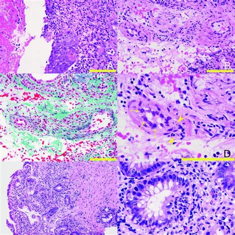 Review Of Nasal Septal Abscess Or Pyoderma Gangrenosum In Patients With Download Scientific