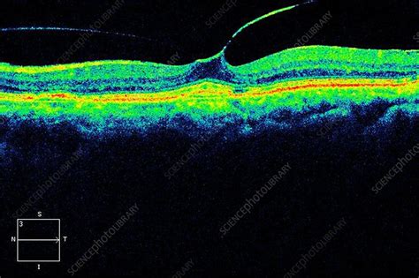 Epiretinal Membrane Oct