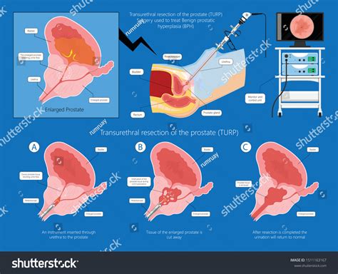 Transurethral Resection Prostate Stricture Urine Bladder Stock Vector