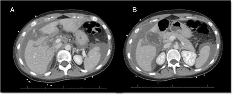 Figure 2 From Gallbladder Necrosis After Right Hepatic Artery